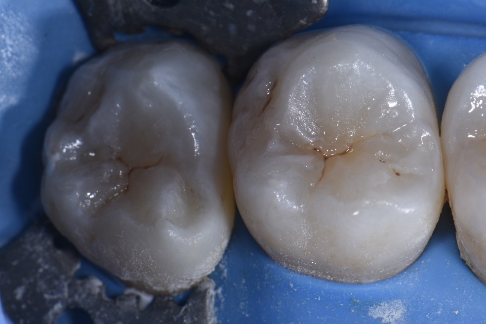 Deep Fissurotomy Restorations