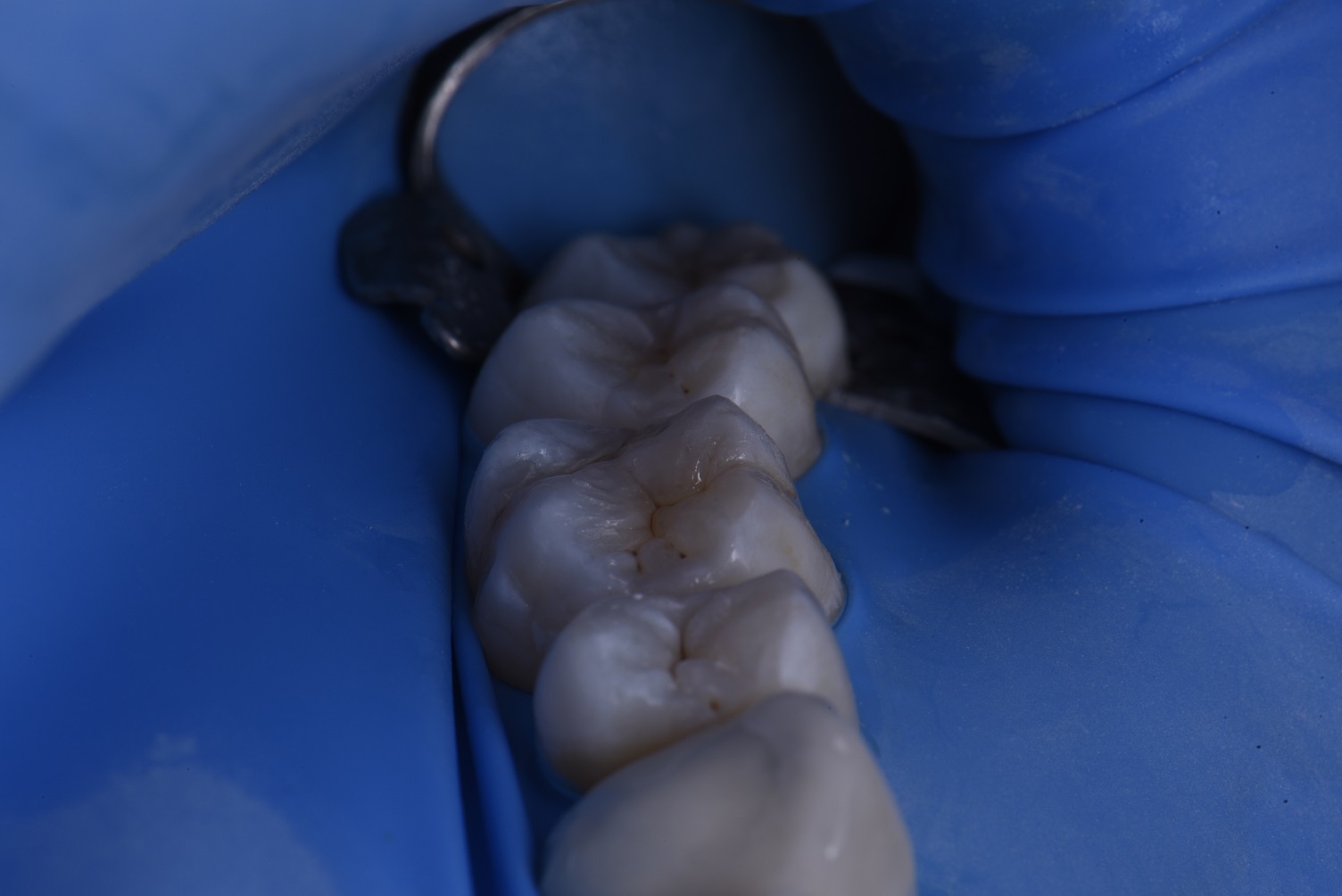 Fissure Exploration and Old Filling Removal
