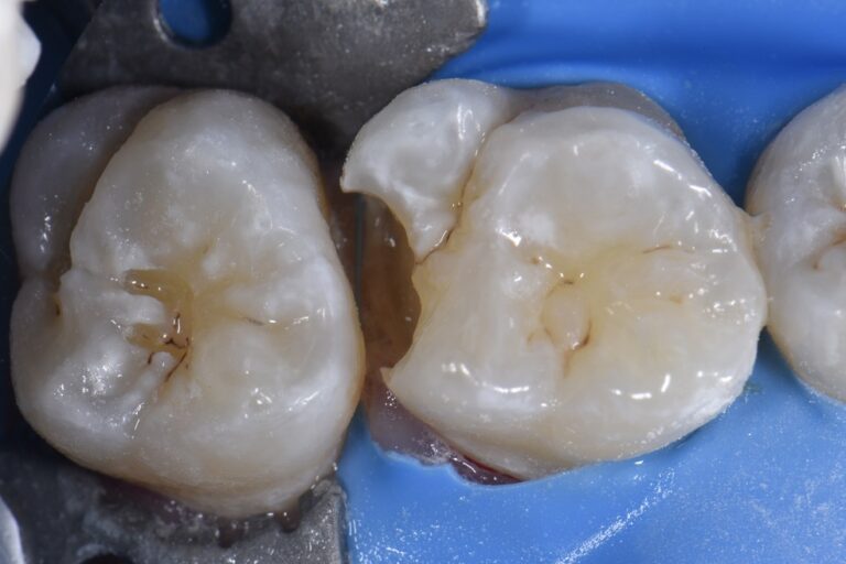 Class II biomimetic composite restorations
