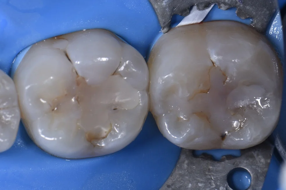 Replacing leaking composite fillings for a young dentist