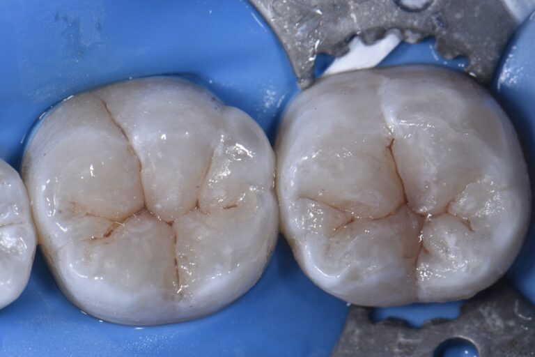 Replacing leaking composite fillings for a young dentist