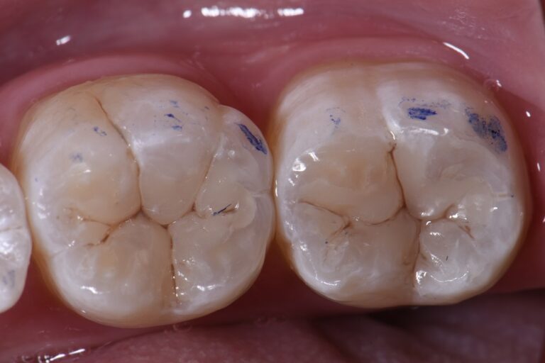 Replacing leaking composite fillings for a young dentist
