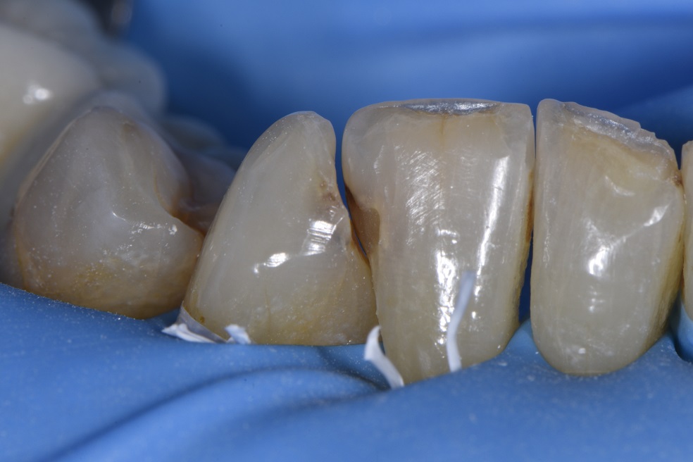 Choosing Shades Pre-operatively with Direct Composite