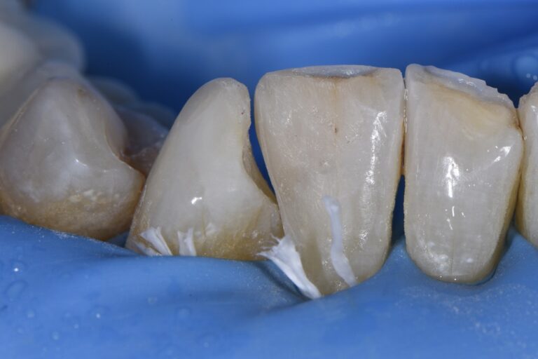 Choosing Shades Pre-operatively with Direct Composite