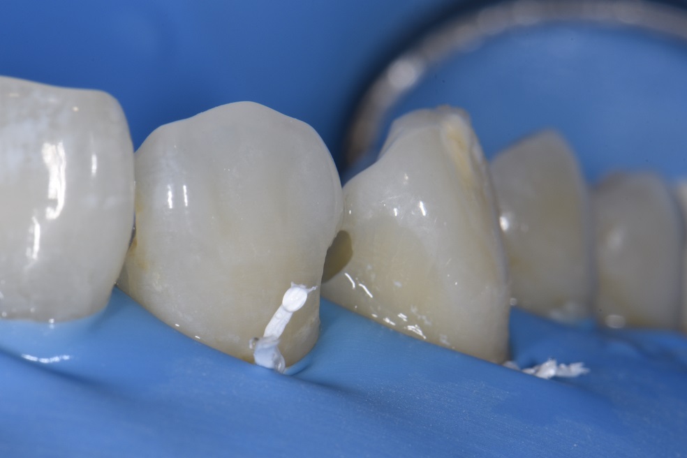 Class III biomimetic restorations