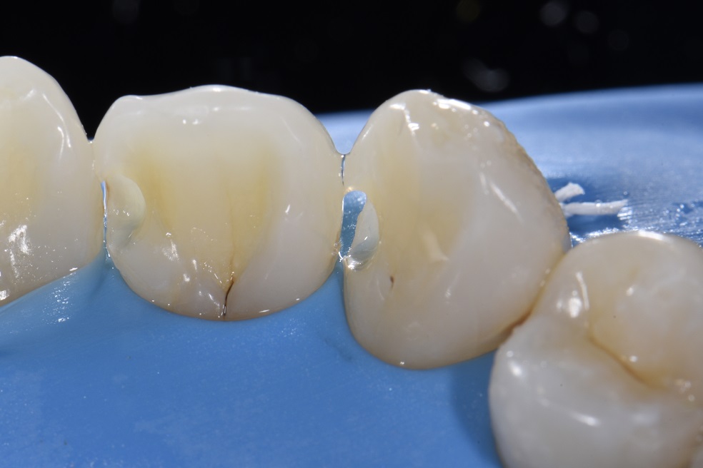 Class III biomimetic restorations