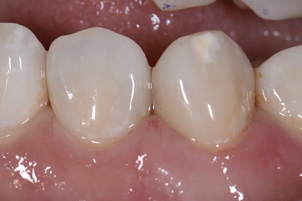 Class III biomimetic restorations