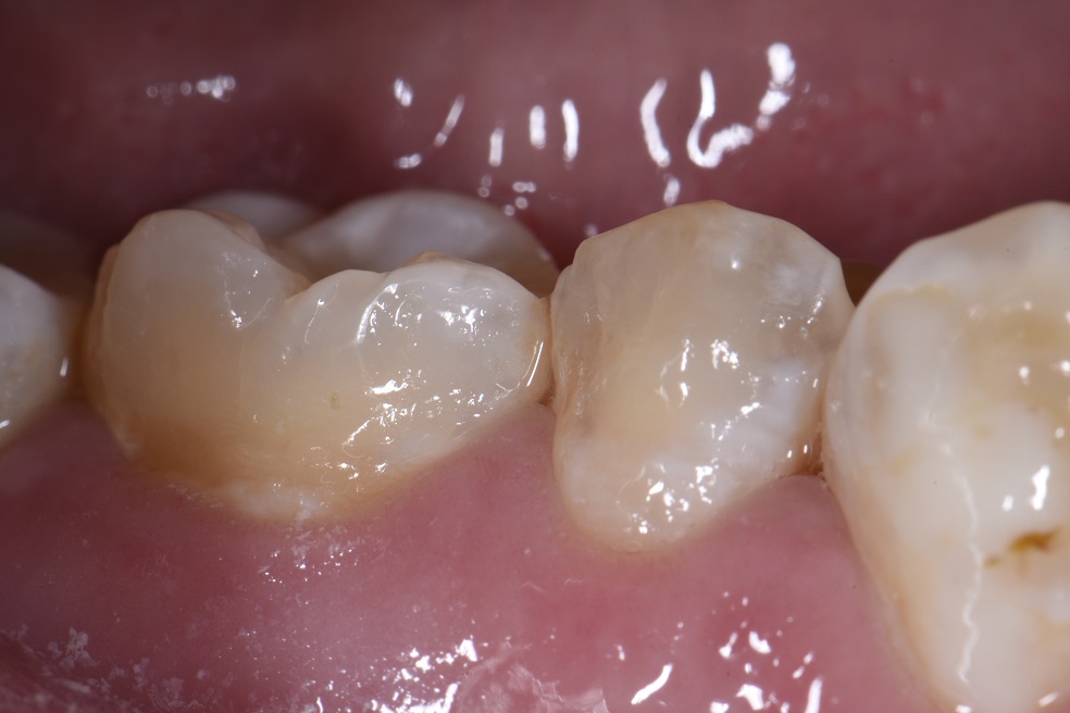 Molar Hypomineralization and Hypoplasia