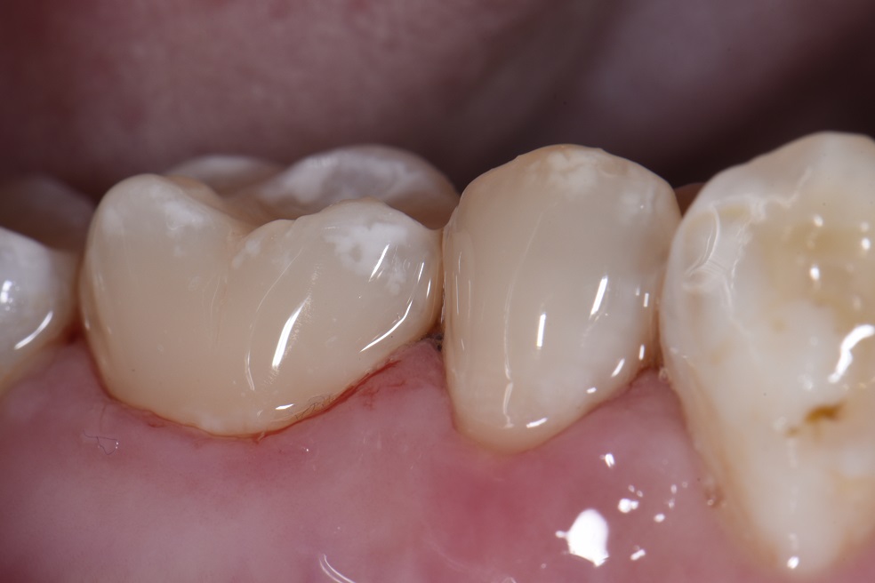 Molar Hypomineralization and Hypoplasia