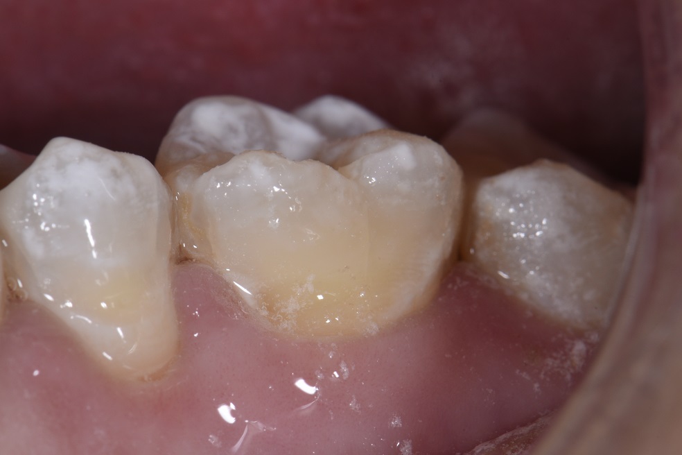 Hypomineralized and Hypoplastic Molar