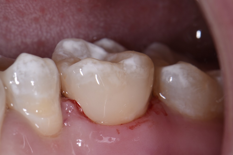 Hypoplastic Molars Children – Children’s Teeth Without Enamel: Causes ...