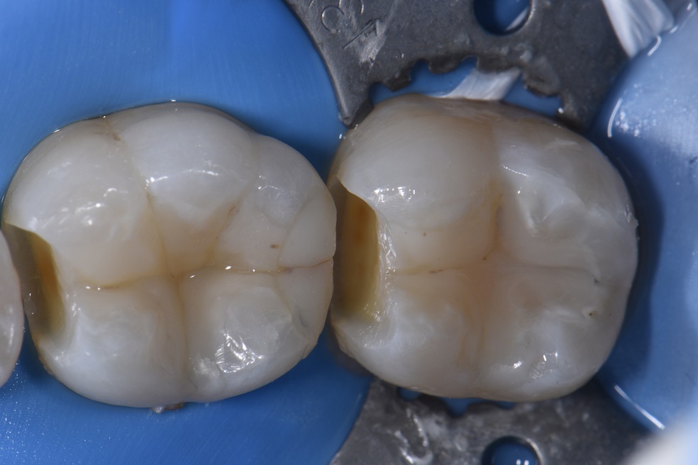 Slot Prep Restorations