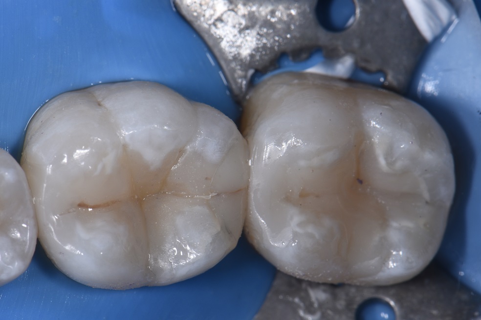 Slot Prep Restorations