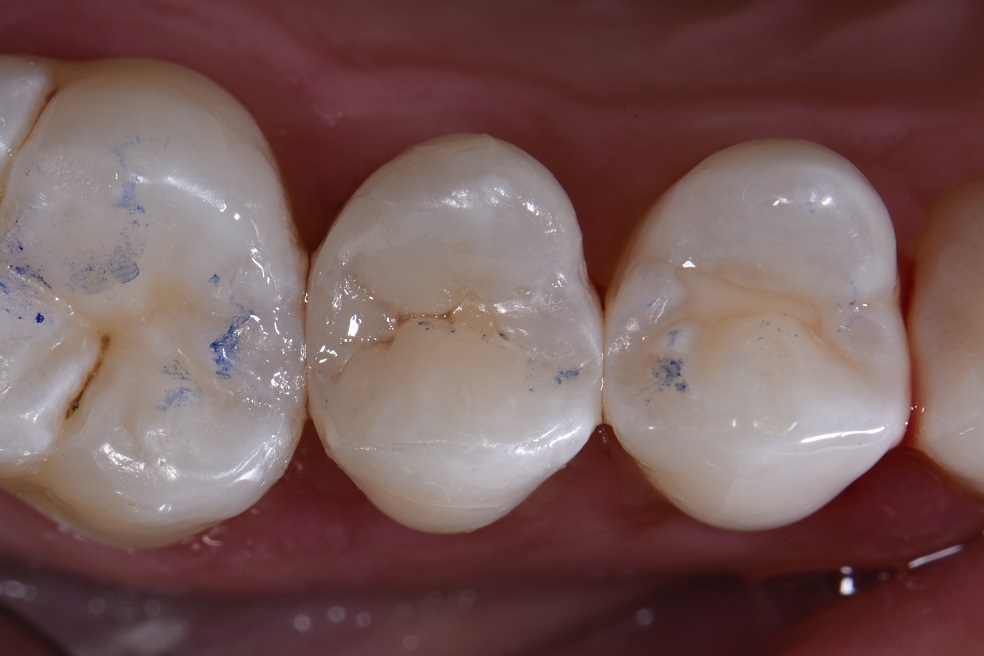 Class II replacement with Voco GrandioSO