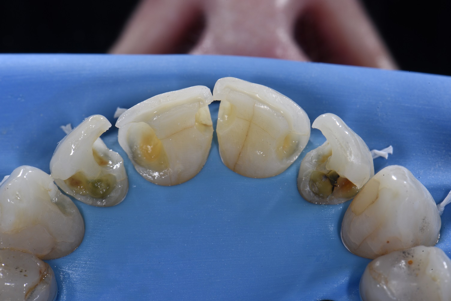 Replacing Old Extensive Composite Fillings