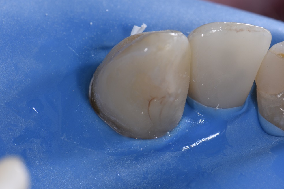 Canine fractures and restorations