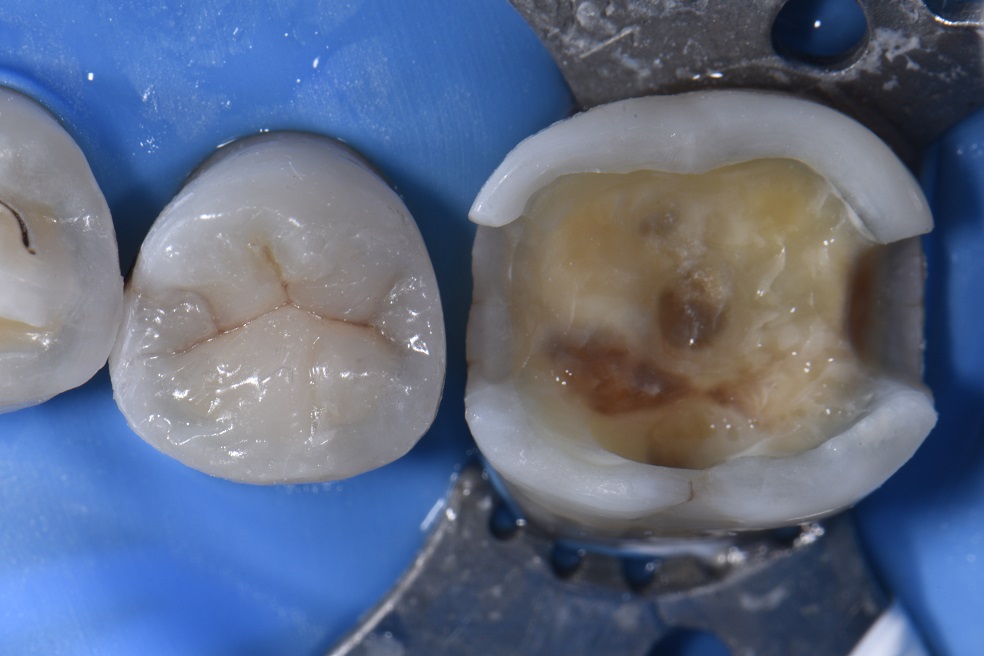Extremely large composite restorations on compromised teeth