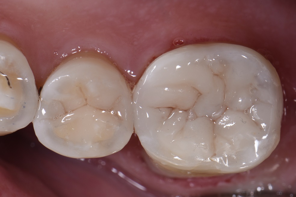 Extremely large composite restorations on compromised teeth