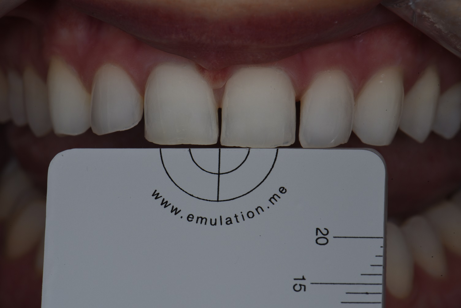 Facially Driven Smile Design