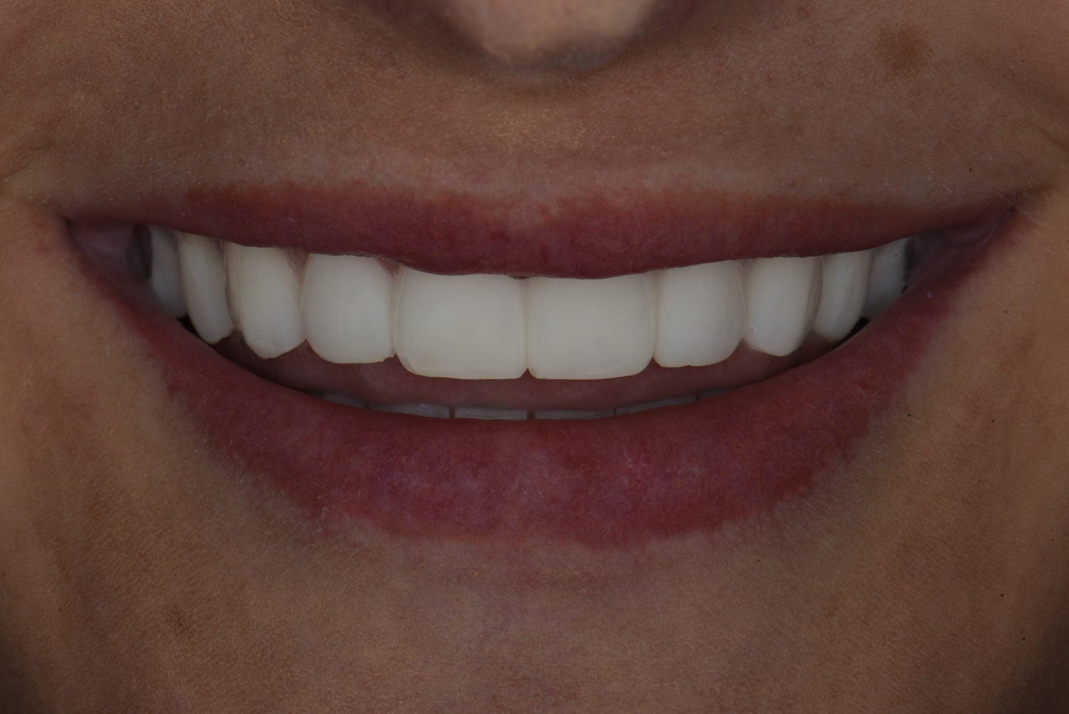 Facially Driven Smile Design