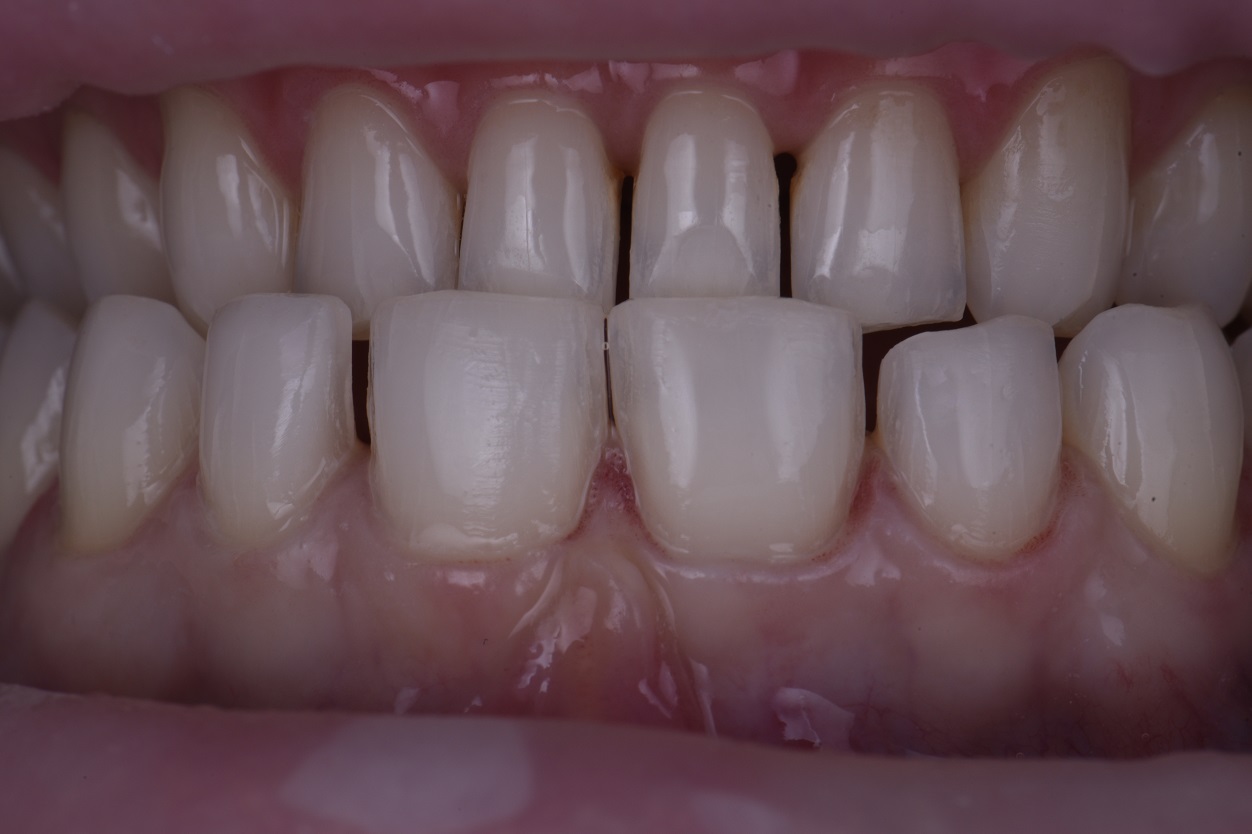 Facially Driven Smile Design