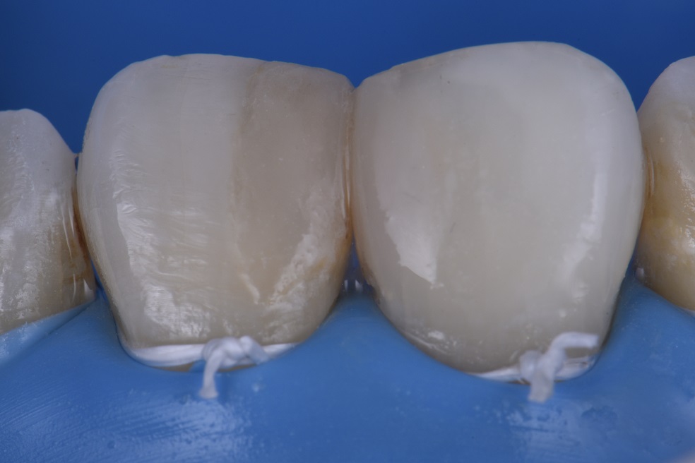 Internal Bleaching and Facial Resurfacing