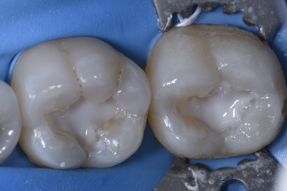 Cavities restored invisibly