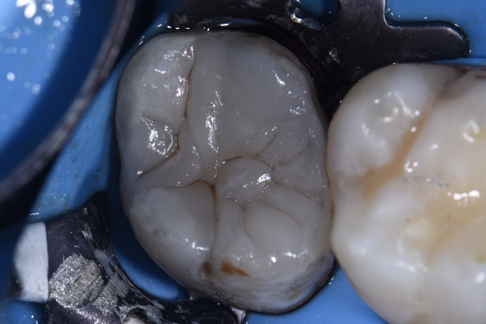 Bonded Core Support for Compromised Teeth