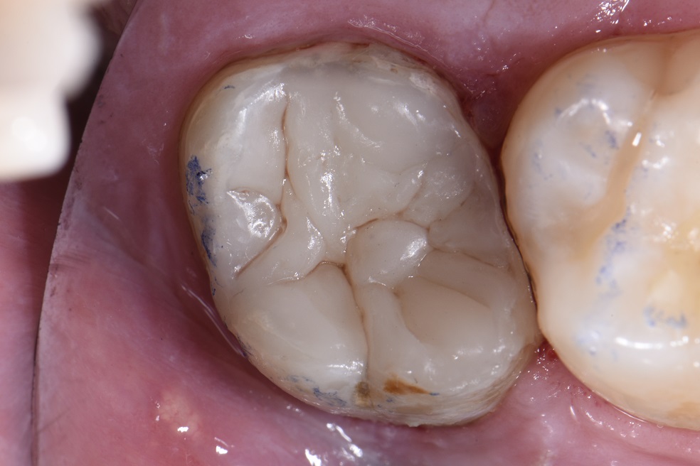 Bonded Core Support for Compromised Teeth