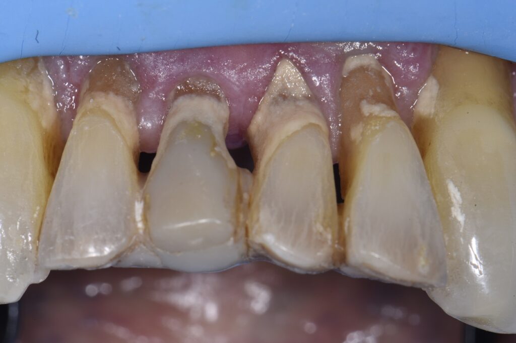 Extreme root abrasion restorations