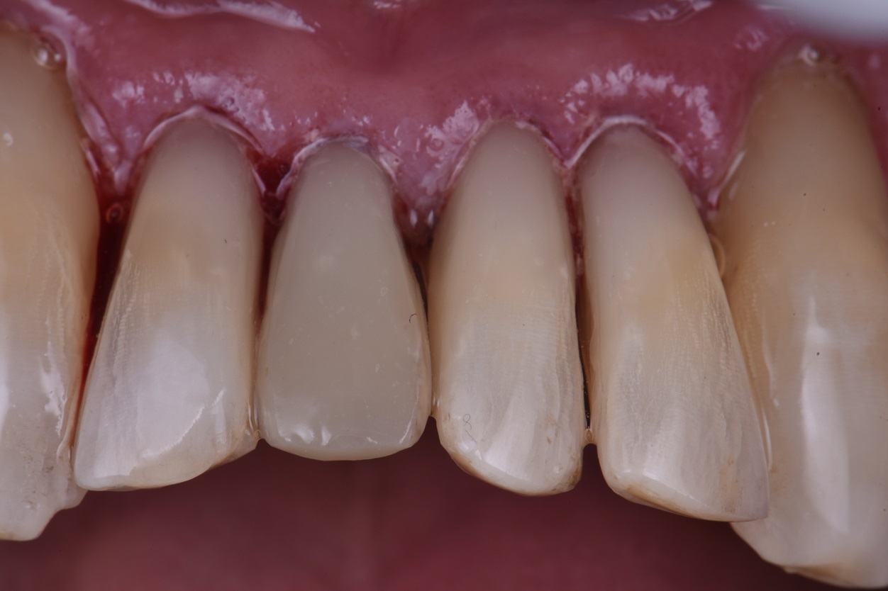 Extreme root abrasion restorations