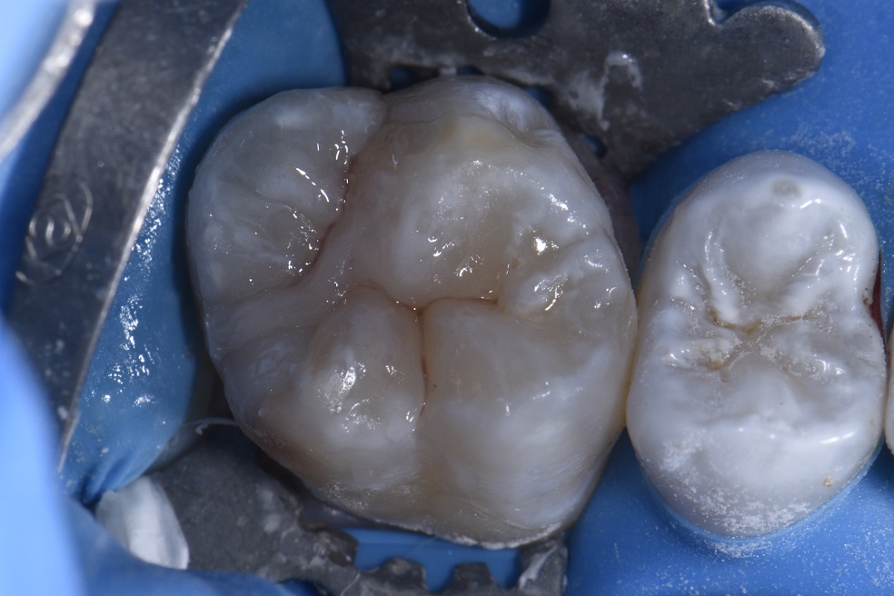 Restoring Failed Restorations on Molar Hypomin