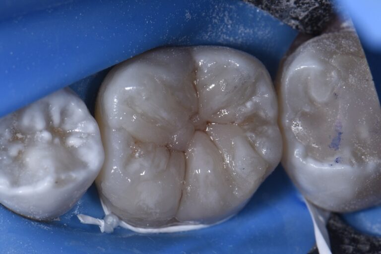 Molar hypomineralization restorations mimicking nature