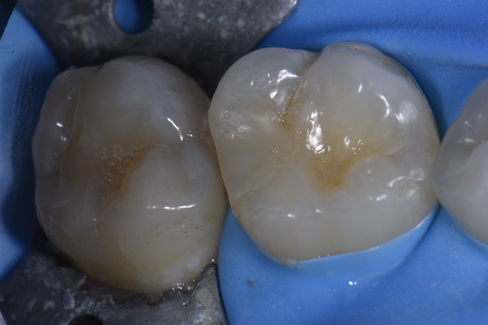 Closing Food Traps using Resin Restorations