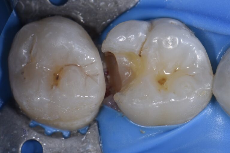 Closing Food Traps using Resin Restorations