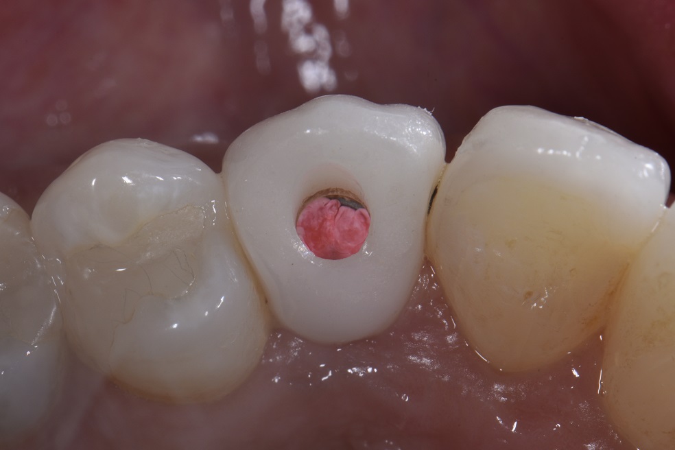 Implant Screw Closures with Composite