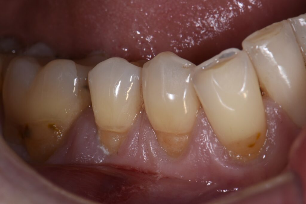 Protecting exposed root surfaces with whitening composite