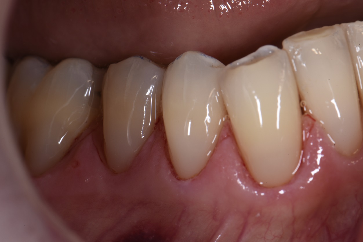 Protecting exposed root surfaces with whitening composite