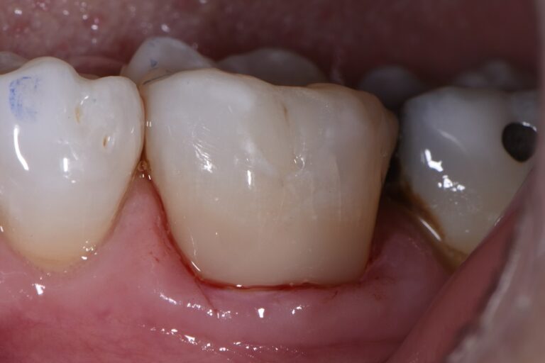 Class V cervical microleakage replaced with microlayered chameleon ...