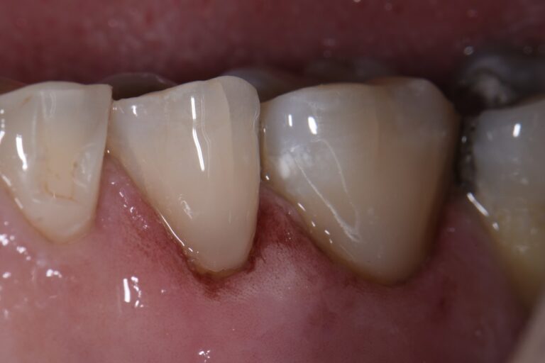 Class V chameleon composite restorations