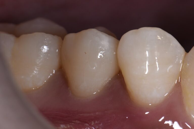 Microdentistry Class V restoration