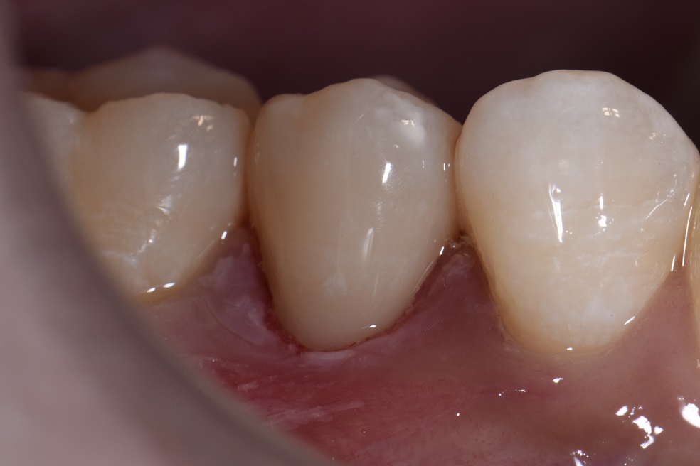 Microdentistry Class V restoration