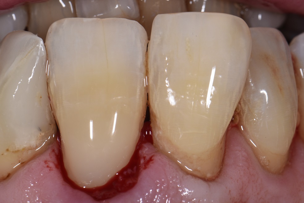 Resurfacing root surfaces prior to gingival grafting