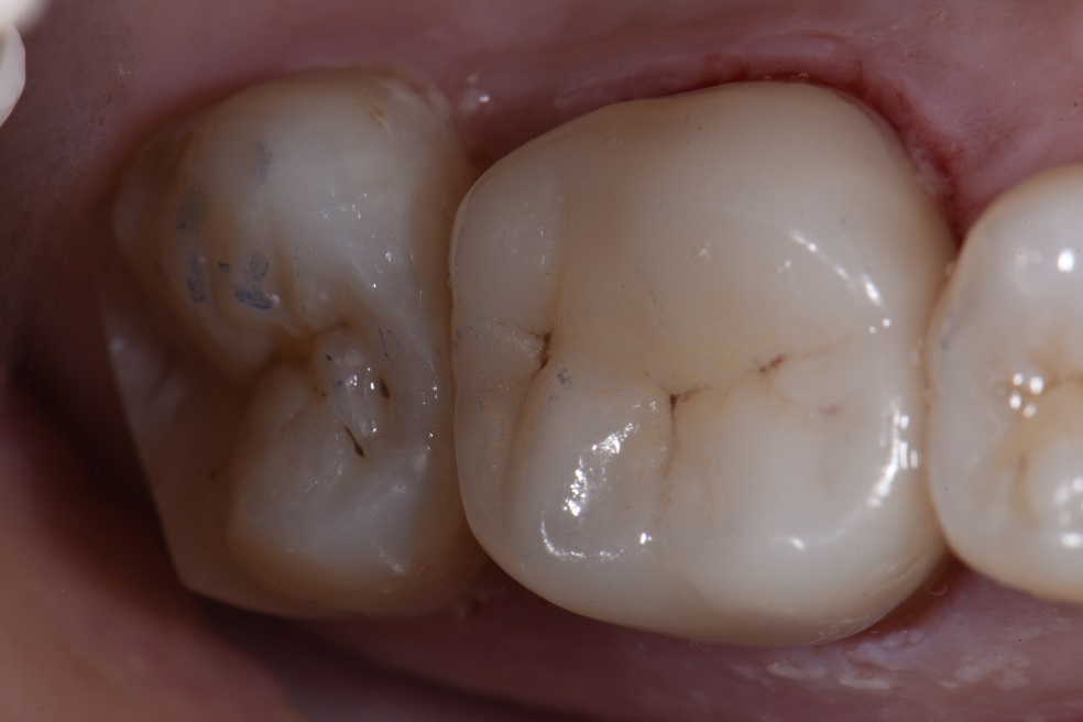 Direct and Indirect Quadrant Dentistry