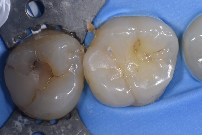 Replacing Old Leaking Fillings with Sculpted Composite Resin
