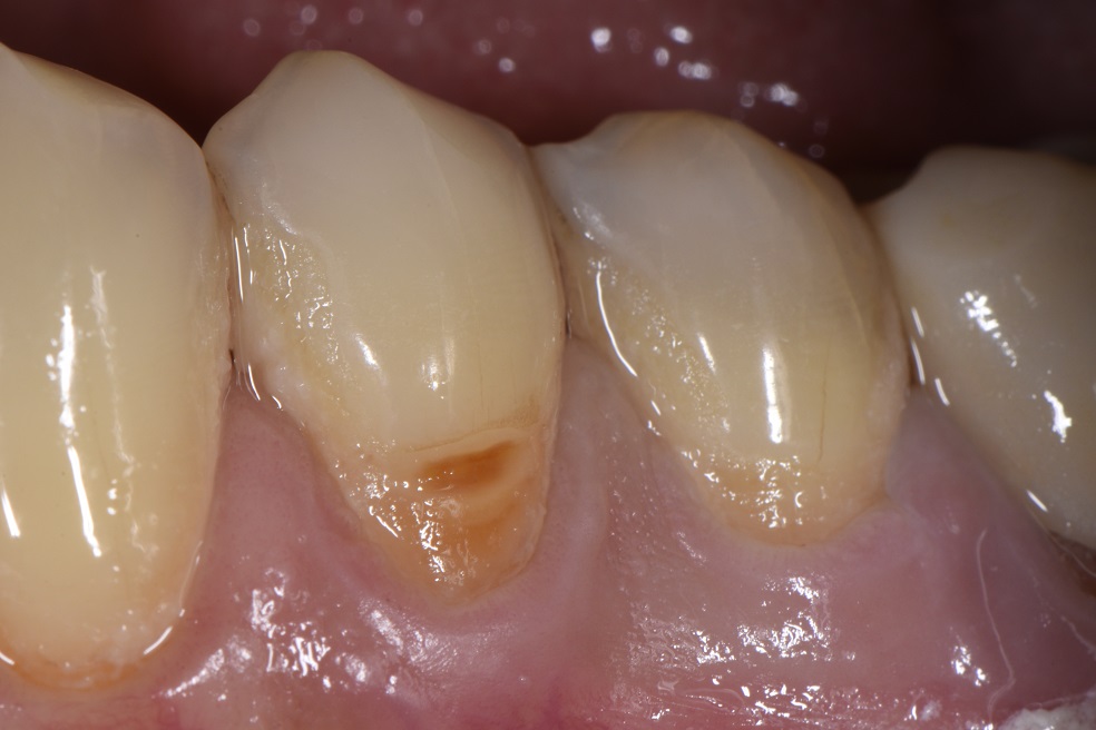 Root cavities made invisible