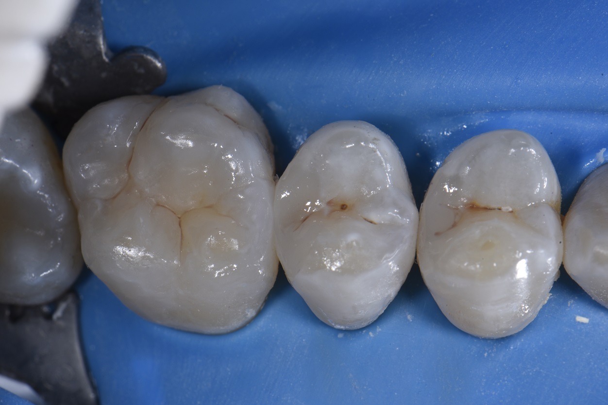 Quadrant Dentistry Invisible Composite Restorations Fillings
