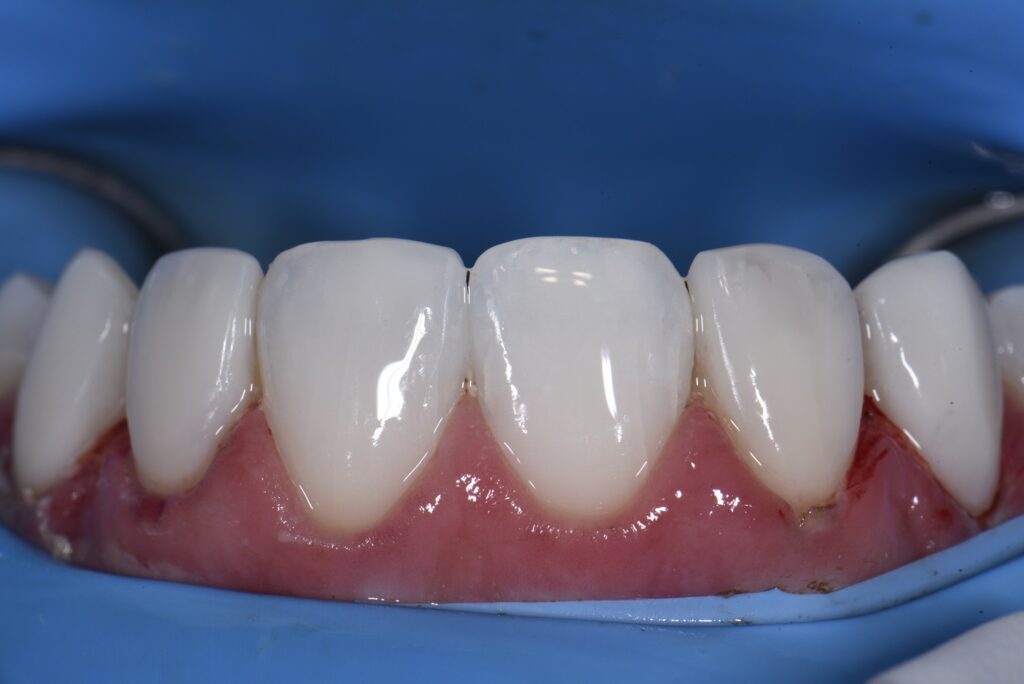 Digital Smile Design driven minimally invasive esthetic dentistry
