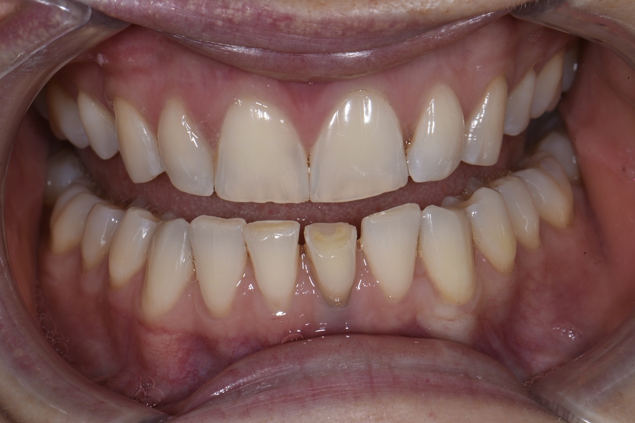 Digital Aligners Invisalign SureSmile PreProsthetic