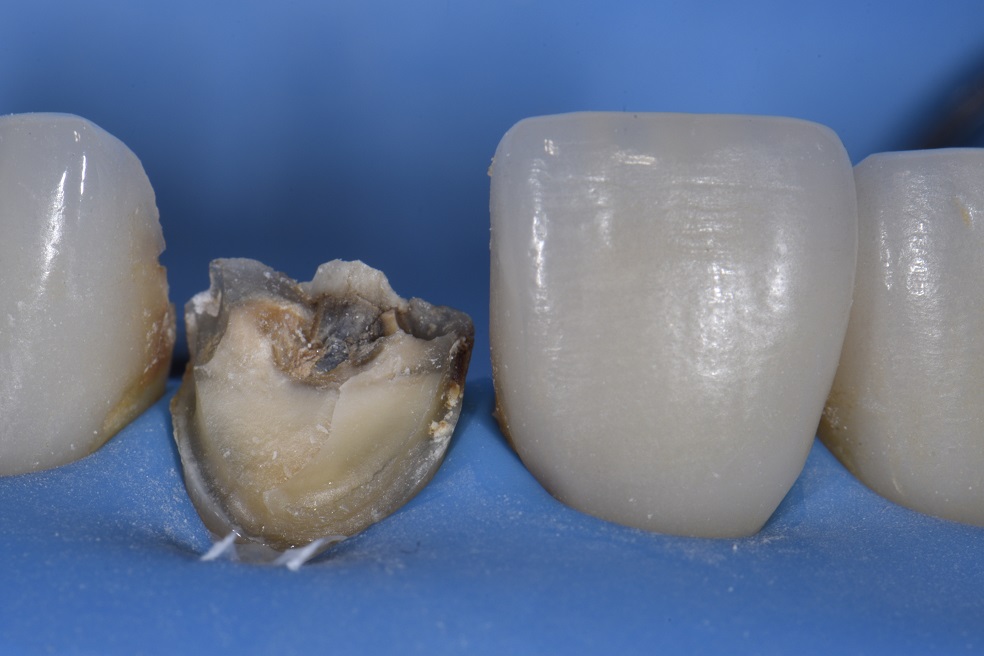 Freehand Composite Crown Fabrication to match Porcelain Veneers